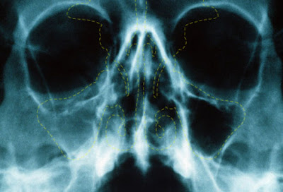 myMRI-CTblog: CHRONIC SINUSITIS