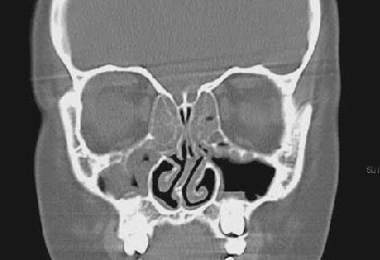 myMRI-CTblog: CHRONIC SINUSITIS