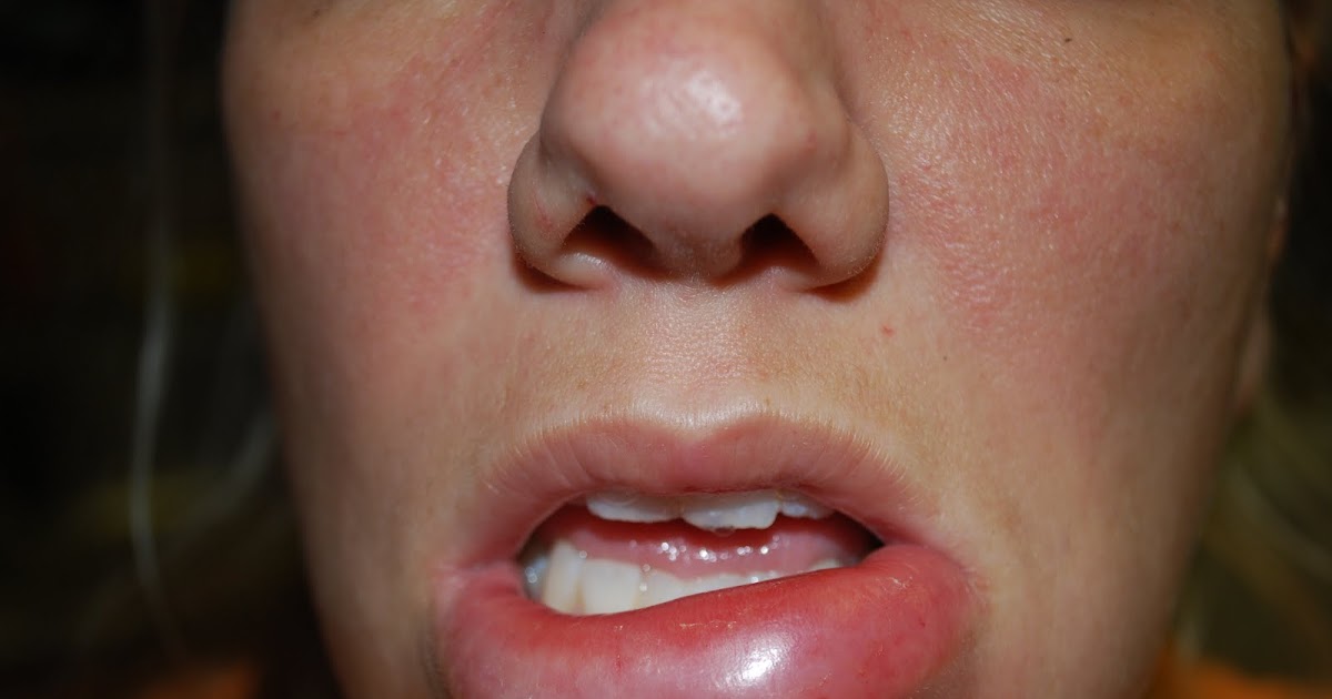 Strouds Loving Life: MRSA pics after 1st drainage