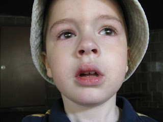 An Apel a Day: Busted Lip