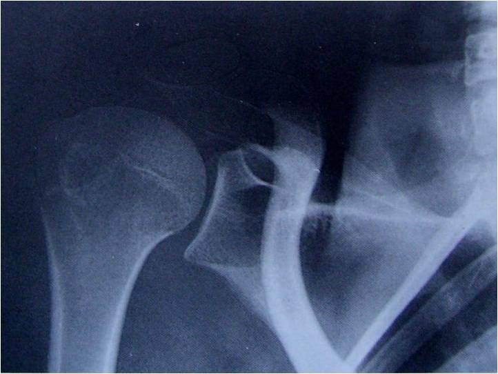 Rayos-5 ;p: ARTICULACION DEL HOMBRO PROYECCION OBLICUA AP(CAVIDAD ...