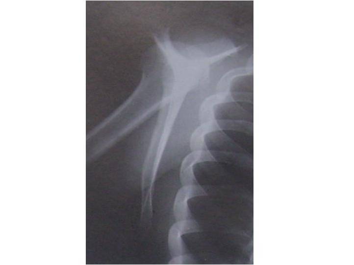 Rayos-5 ;p: ESCAPULA PROYECCION LATERAL