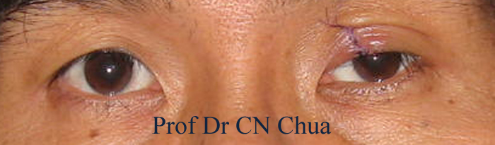 Eyelid Surgery by Prof Dr CN CHUA 蔡鐘能: How I Managed the Lost Eyelashes