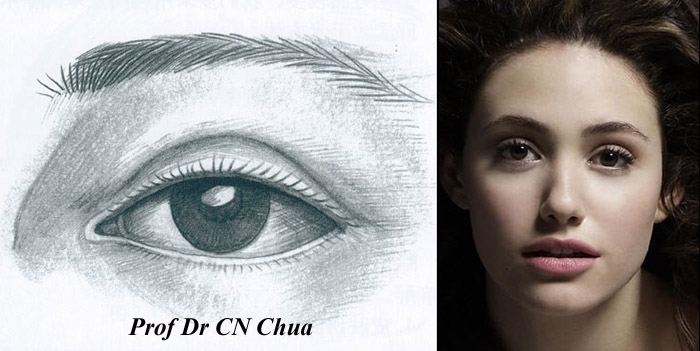Eyelid Surgery by Prof Dr CN CHUA 蔡鐘能: What Type of Double Eyelid Do ...