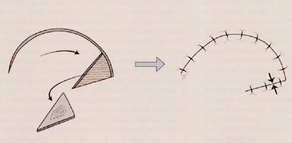 Eyelid Surgery by Prof Dr CN CHUA 蔡鐘能: Case 2: Excision of Basal Cell ...