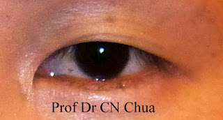 Eyelid Surgery by Prof Dr CN CHUA 蔡鐘能: The Joys and Pitfalls of Suture ...