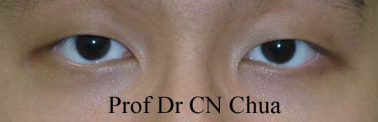Eyelid Surgery by Prof Dr CN CHUA 蔡鐘能: The Joys and Pitfalls of Suture ...