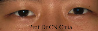 Eyelid Surgery by Prof Dr CN CHUA 蔡鐘能: The Joys and Pitfalls of Suture ...