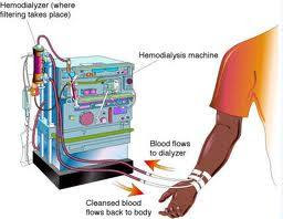 Penyakit Ginjal & Hipertensi: Bagaimana akses Cuci darah/ Hemodialisys