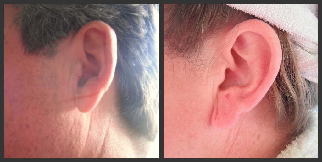 La herencia de las generaciones: LÓBULO DE LA OREJA