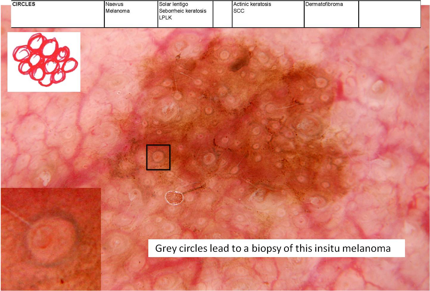 Introduction to Dermatoscopy