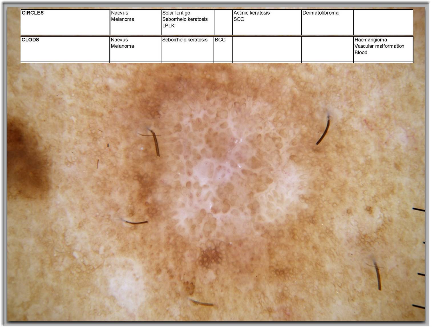 Introduction to Dermatoscopy