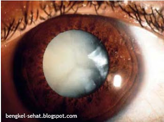 Bengkel Sehat: Katarak