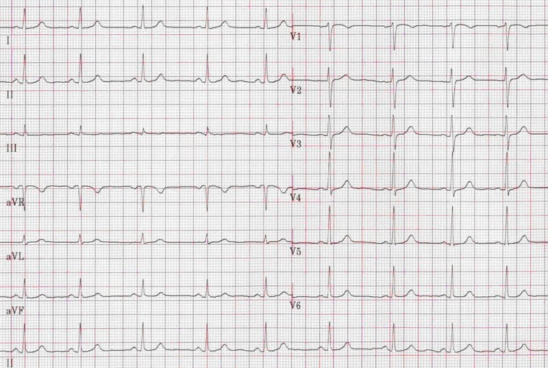 Blog do ECG: Traçado e ECG Normal 1