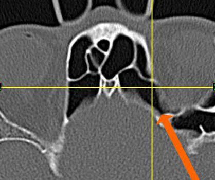 JKSIOWMD: Frontal Recess Anatomy