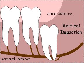Wisdom Tooth: Impacted Wisdom Tooth