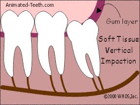 Wisdom Tooth: Impacted Wisdom Tooth