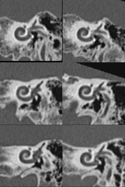 la neuroimagen: TC de oídos (Temporal bone CT)