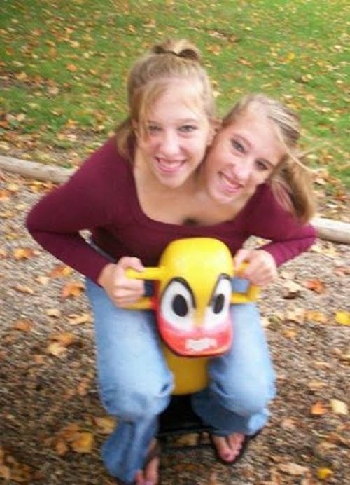 All The Facts At One Place: Dicephalic Conjoined Twins