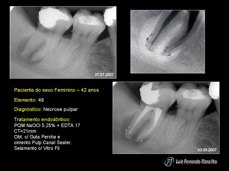 CANAL MANCILHA: Controle Radiográfico - Elemento 48 - Necrose Pulpar