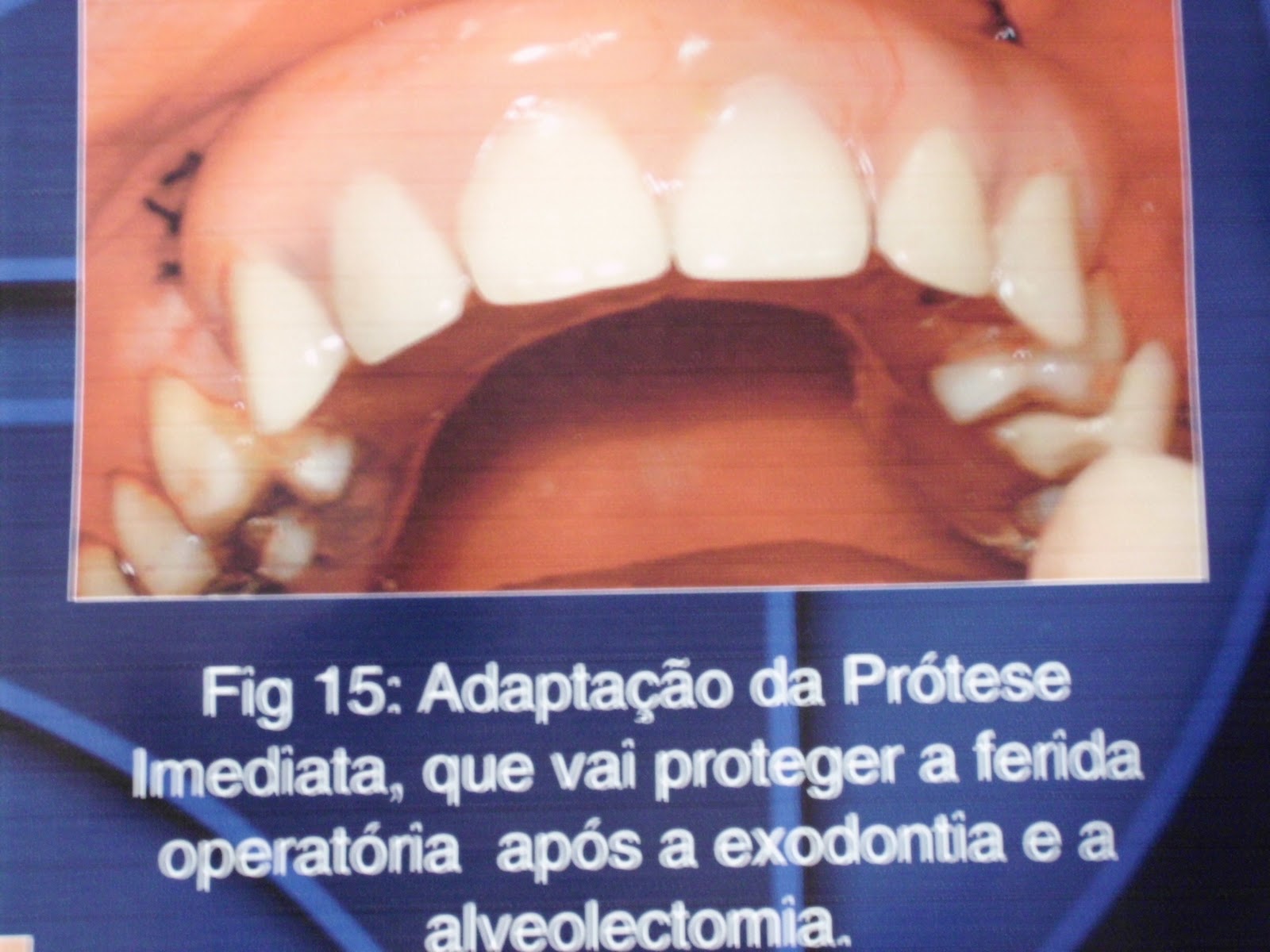 Caso Clínico- Alveolectomia Intra-septal ~ OCEF-Reabilitação Oral