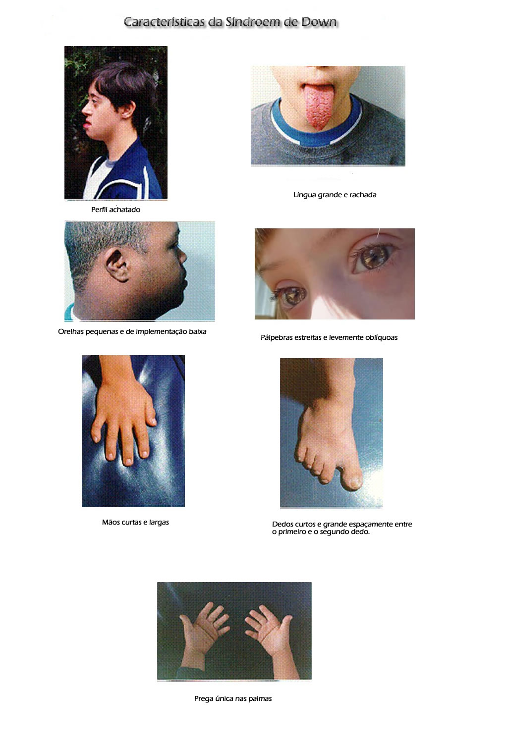 Trissomia 21: Imagens