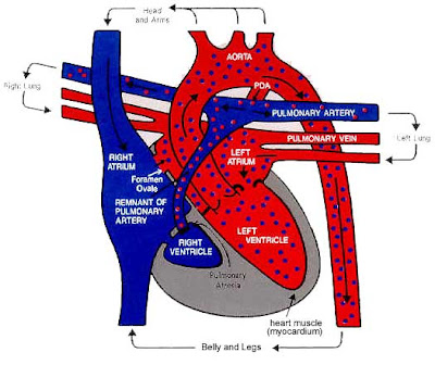 Life As A Pediatric Nurse: Hypoplastic Right Heart Syndrome