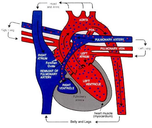 Life As A Pediatric Nurse Hypoplastic Right Heart Syndrome