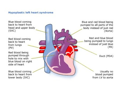 Life As A Pediatric Nurse: Hypoplastic Left Heart Syndrome (HLHS)