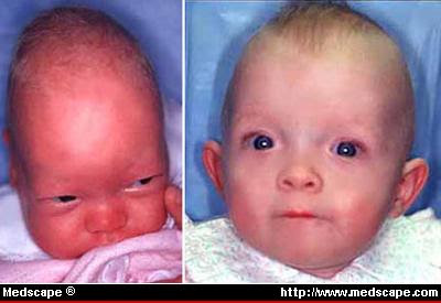 Life As A Pediatric Nurse: Scaphocephaly with Craniofacial Surgery