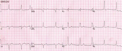Wolff-Parkinson-White Syndrome | Paramedicine 101