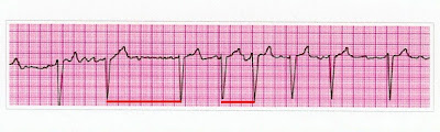 The Electrocardiogram - Part V | Paramedicine 101