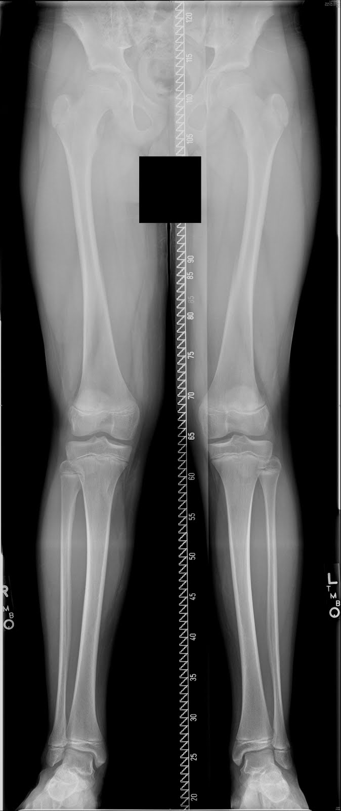 The Galat Family: Knock-Knees and the Navicular Bone