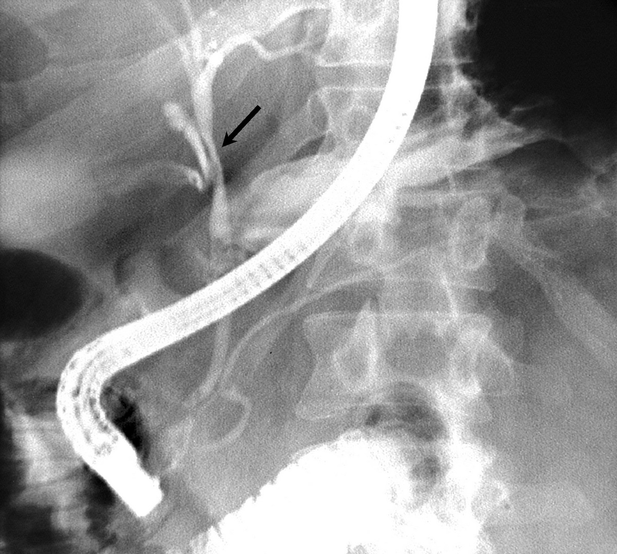 AK-47: Mirizzi Syndrome