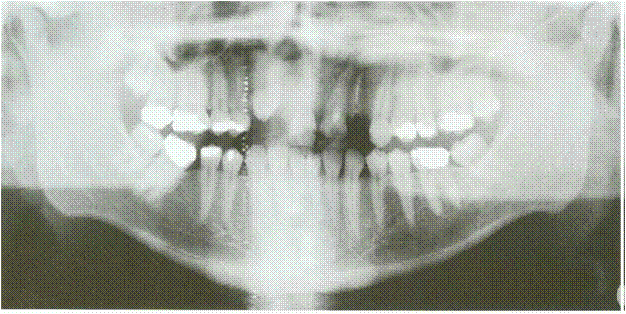 Dentistry: Retained Root