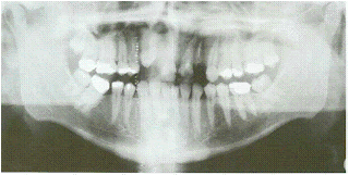 Dentistry: Retained Root