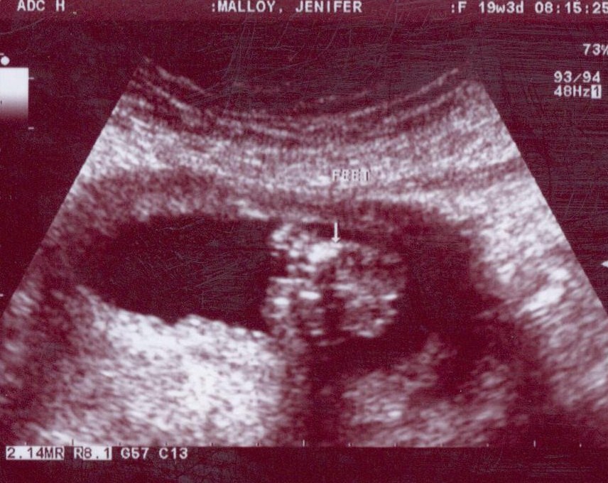 20 Week Ultrasound | The Malloy Clan