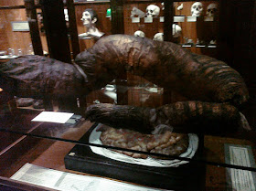 Mutter Museum Colon
