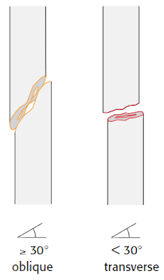 11:50: Fractura Oblicua / Transversa