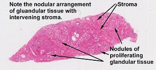 The Pathology Anatomi: Hiperplasia prostat