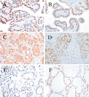 The Pathology Anatomi: adenomatous goiter