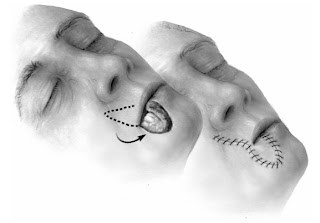 surgical operations: Facial skin cancers