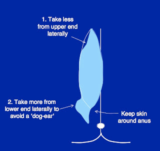 surgical operations: Pilonidal sinus: Karydakis procedure