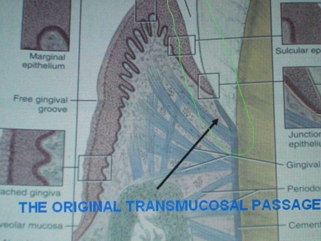 THE TRANSMUCOSAL PASSAGE OF THE DENTAL IMPLANT AND THE THREE CRITICAL ...
