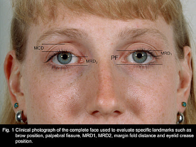 healthylifeandbeauty.com: Eyelid Crease Examination