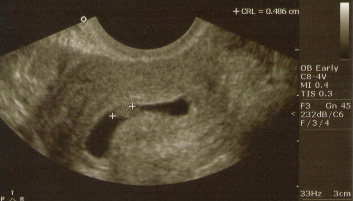 Excellent Eggs (now bad eggs) + Super Sperm + Unicorn Uterus =: 6 weeks ...