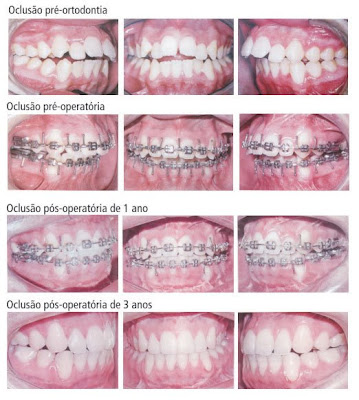 clinica carlos dantas: Publicação na Revista Dental Press - Tratamento ...