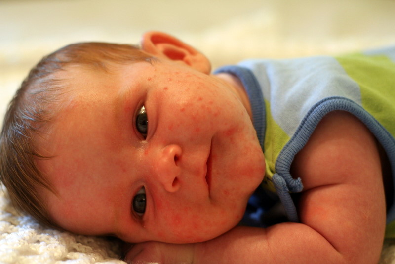 In Everything...: 5 Weeks & umbilical granuloma