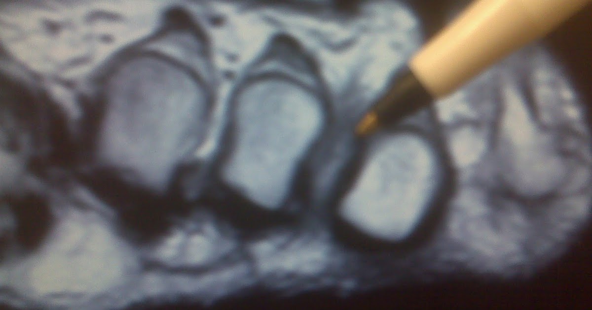 Foot and Ankle Problems By Dr. Richard Blake: Morton's Neuromas: Which ...