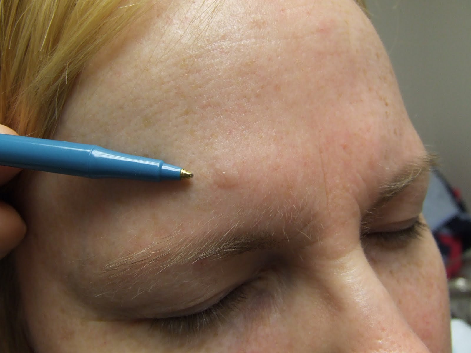 Got Skin? Must Read: A Perspective on Skin Cancer: The Day After